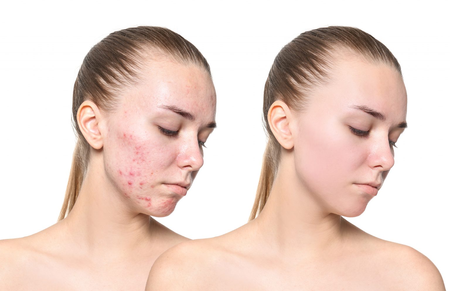 Acne behandeling - Helemaal Huid